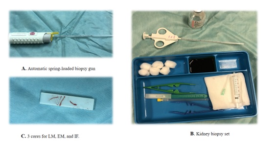 Native Kidney Biopsy: An Update and Best Practice Evidence